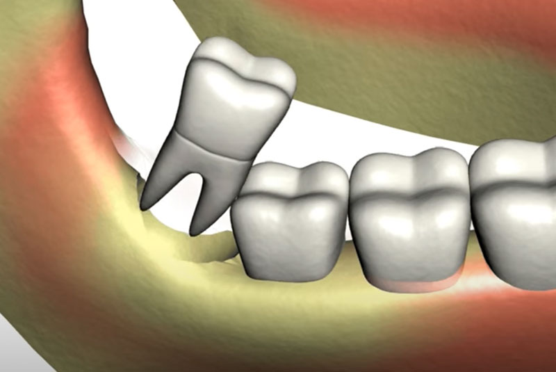 Oral Surgery Niceville - Wisdom Teeth Extractions Destin & Niceville ...